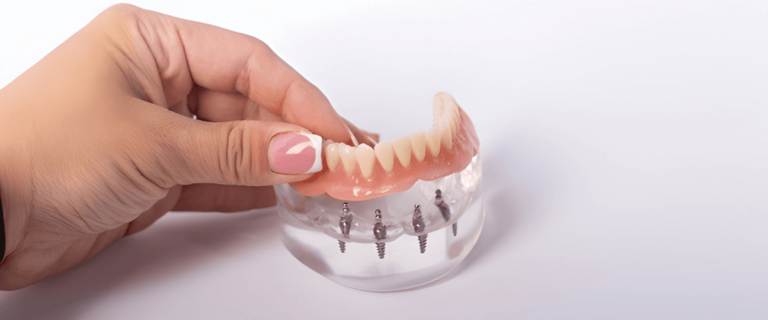 Dental Implants - Vegamedicalcenter.ae